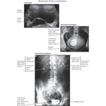 Ureterocele: Radiographic Findings