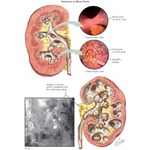 Urolithiasis: Appearance of Renal Stones