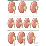 Pyeloplasty and Endopyelotomy