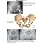 Innominate Osteotomy (Continued)