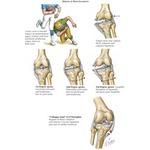 Sprains of Knee Ligaments