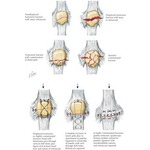 Fracture of the Patella
