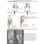 Knee Arthroplasty: Total Condylar Prosthesis and Unicompartmental ...