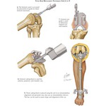 Total Knee Replacement Technique: Steps 6 to 9