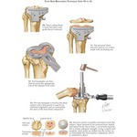 Total Knee Replacement Technique: Steps 10 to 14