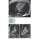 Cardiac Magnetic Resonance Imaging