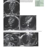 Cardiac Magnetic Resonance Imaging (Continued)