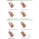 Percutaneous Aortic Valve (Edwards Sapien and CoreValve) Replacement