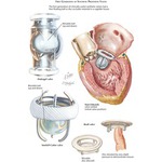 First Generation of Synthetic Prosthetic Valves