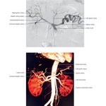 Celiac Arteriogram and CT Angiogram