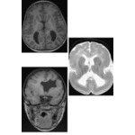 Neuronal Proliferation and Migration Disorders