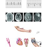 Clinical Evaluation and Therapeutic Options in Stroke (Continued)