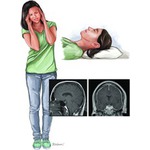 Intracranial Hypotension/ Low Cerebrospinal Fluid Pressure Headache