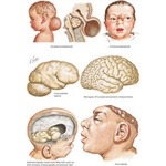 Brain Malformations