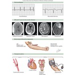 Clinical Evaluation and Therapeutic Options in Stroke (Continued)