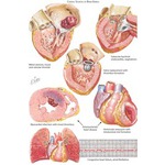Cardiac Sources of Cerebral Emboli