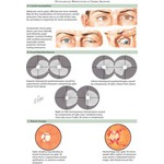 Ophthalmologic Manifestations of Cerebral Aneurysms