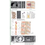 Tumors of Spinal Column