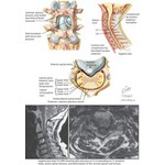 Cervical Disk Herniation Causing Cord Compression