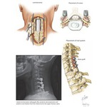 Posterior Cervical Stabilization and Fusion