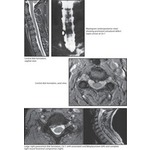 Radiographic Diagnosis of Radiculopathy