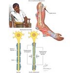 Compression Neuropathies