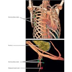 Lymph Nodes of the Axilla (Continued)