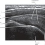 Shoulder Joint: Supraspinatus Muscle (Continued)
