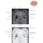 Soft Tissue and Lung Coronal 1