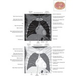Soft Tissue and Lung Coronal 6