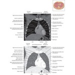 Soft Tissue and Lung Coronal 7