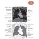 Soft Tissue and Lung Coronal 16