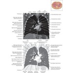 Soft Tissue and Lung Coronal 20