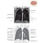 Soft Tissue and Lung Coronal 26