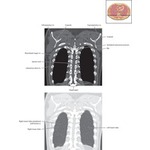 Soft Tissue and Lung Coronal 33