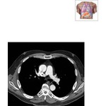 Cisterna Chyli/Thoracic Duct Axial 3