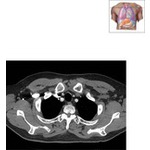 Cisterna Chyli/Thoracic Duct Axial 5