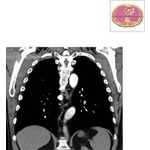 Cisterna Chyli/Thoracic Duct Coronal 1