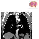 Cisterna Chyli/Thoracic Duct Coronal 4
