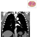 Cisterna Chyli/Thoracic Duct Coronal 5