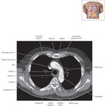 Cisterna Chyli/Thoracic Duct Axial 4