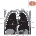 Cisterna Chyli/Thoracic Duct Coronal 2