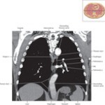 Cisterna Chyli/Thoracic Duct Coronal 4