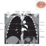 Cisterna Chyli/Thoracic Duct Coronal 6