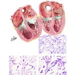 Primary Heart Tumors
