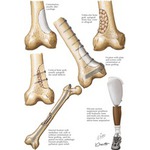 Reconstruction after Partial Excision or Curettage of Bone (Fracture ...