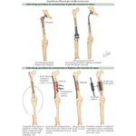 Limb-Salvage Procedures for Reconstruction