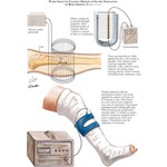 Noninvasive Coupling Methods of Electric Stimulation of Bone