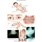 Osteogenesis Imperfecta
