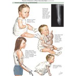 Failure of Formation of Parts: Transverse Arrest (Forearm amputation ...